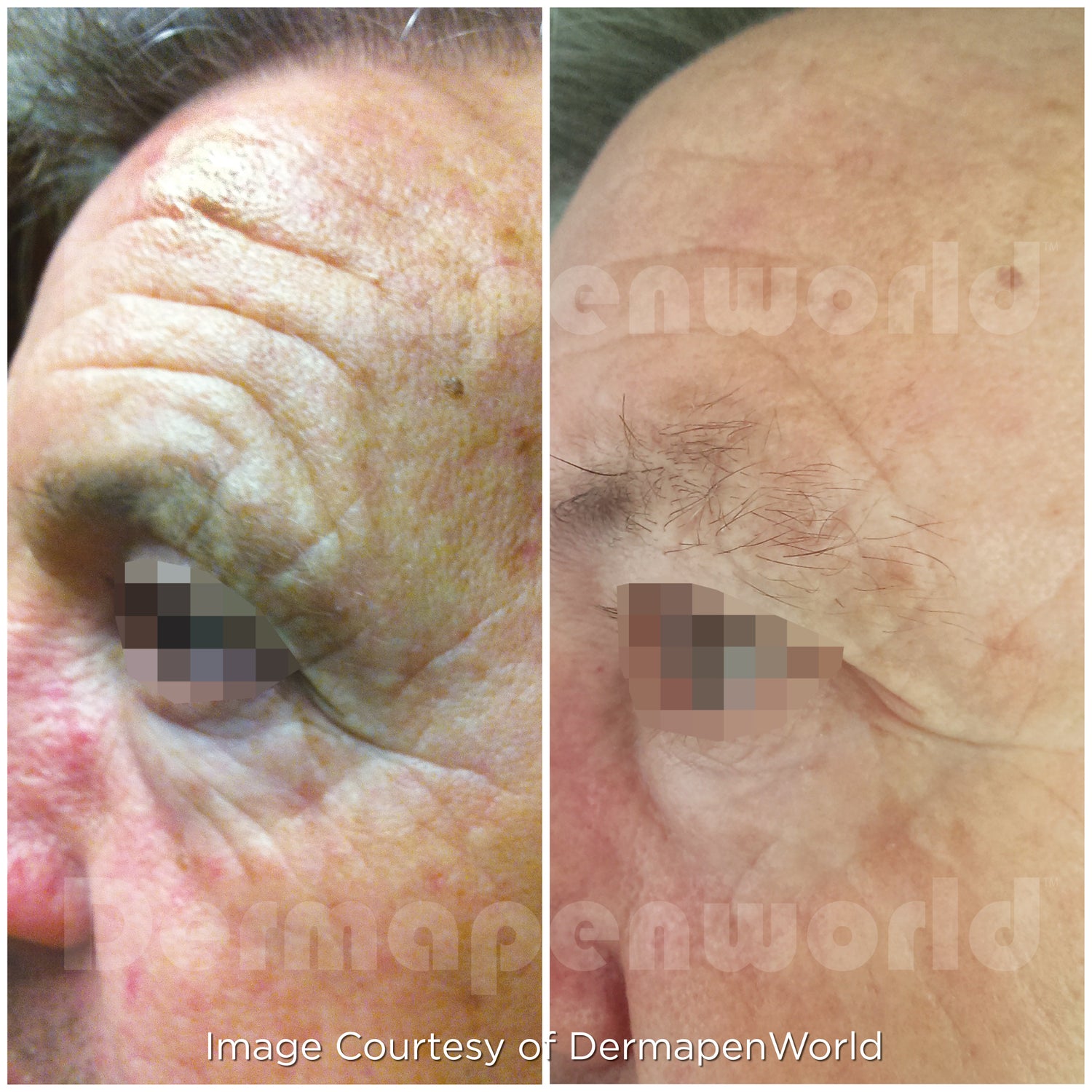 Dermapen Microneedling – Dermapenworld UK