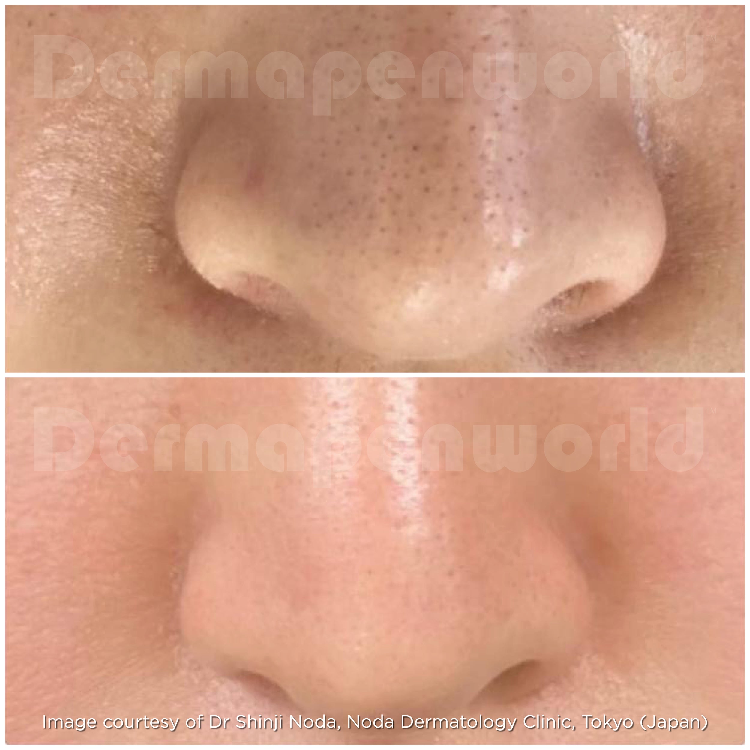 Enlarged Pores Treatment – Dermapenworld UK