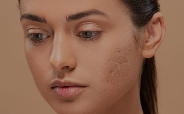 Scar Treatment – Dermapenworld UK